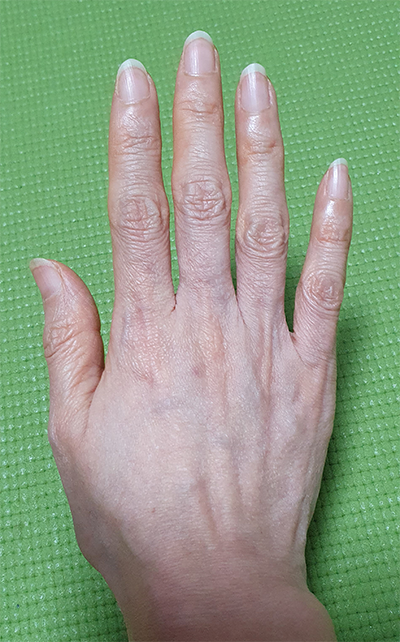 사구체 종양 문의 - 전문의상담